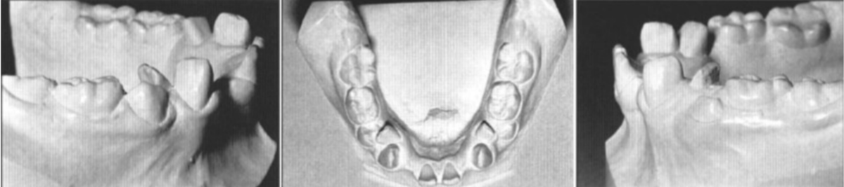Unlocking the Mystery of Transposed Teeth