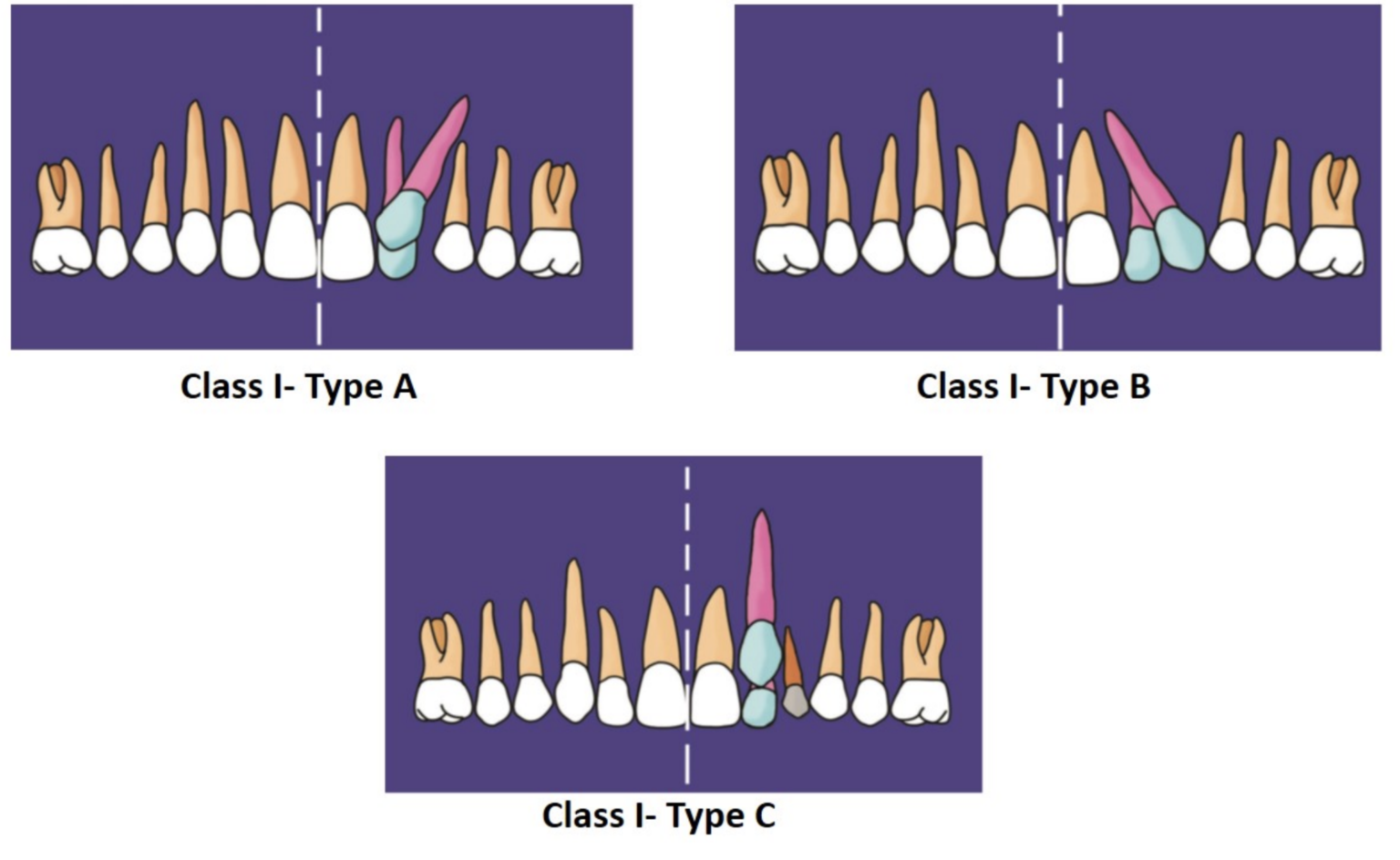 Unlocking the Mystery of Transposed Teeth