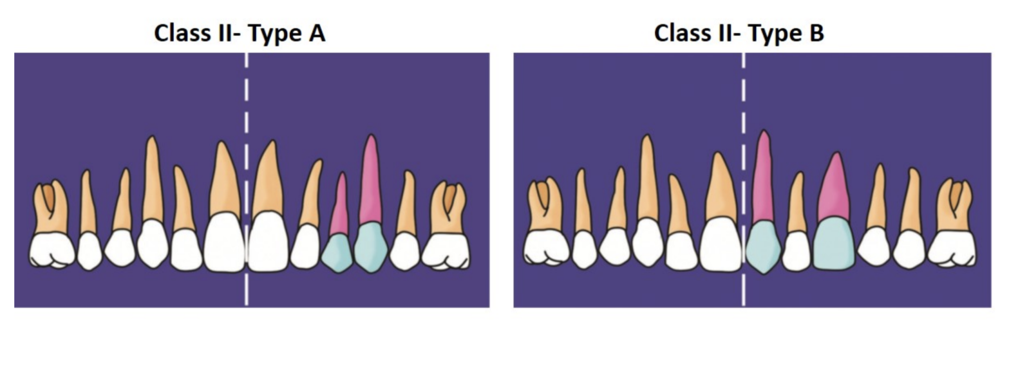Unlocking the Mystery of Transposed Teeth